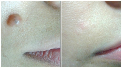 Mole removal | Vital Face & Vein